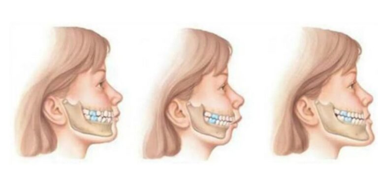 What Is Malocclusion and How to Fix It | 6 Key Facts