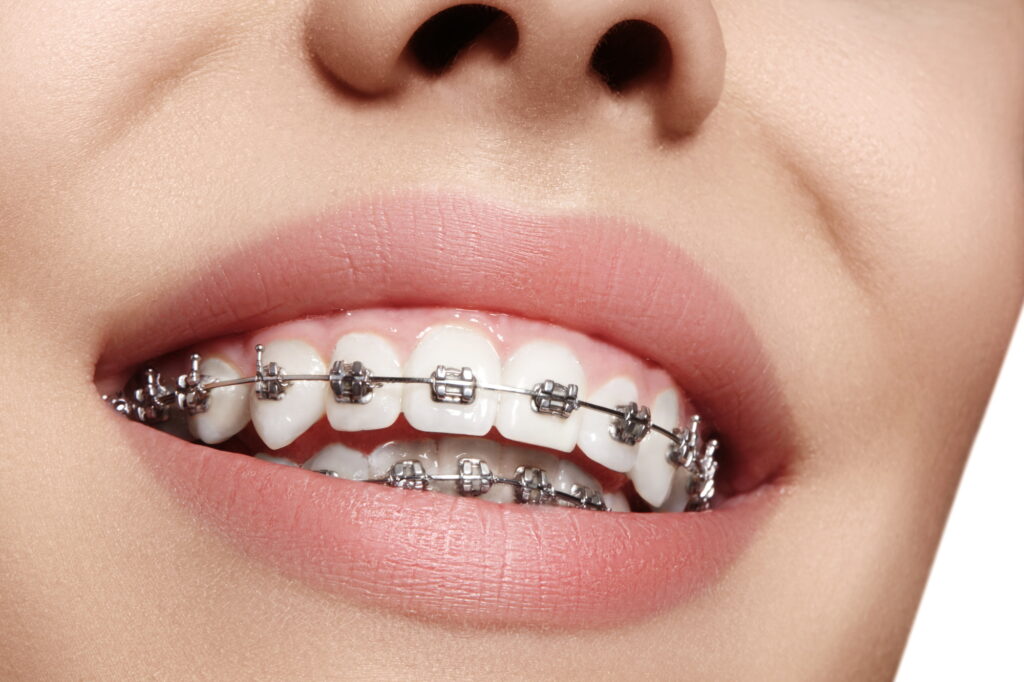 5 Safe Steps to Handle a Broken Braces Wire
